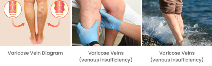 Varicose Vein Treatment Services | Clayton Medical Health